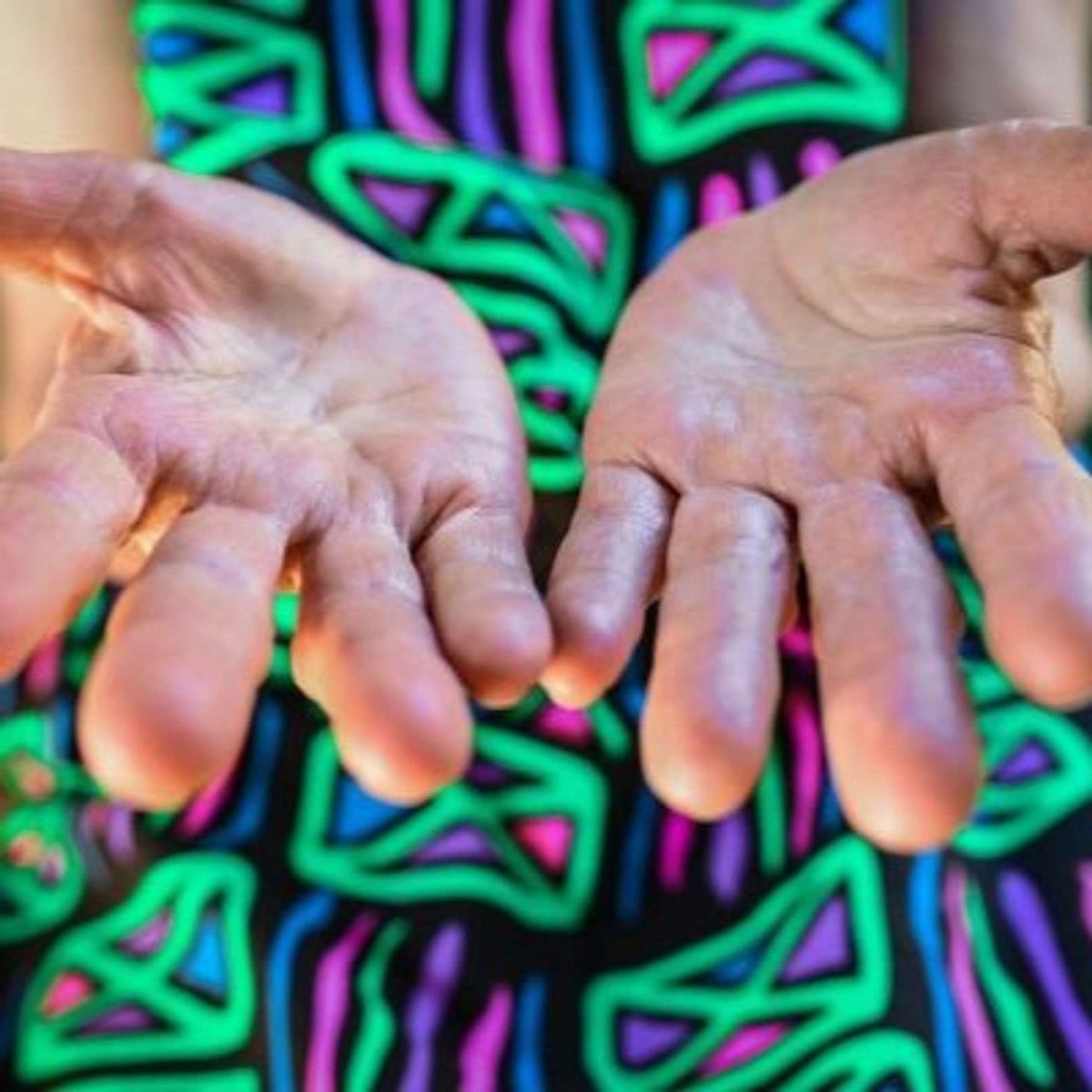 Estrogen Inflammation: How Menopause Affects Your Body